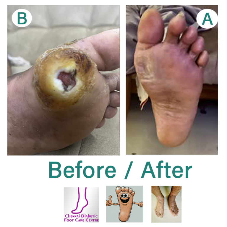 Chennai Diabetic Foot Care Centre | Ph: 9840525242 | Dr. Premkumar ...