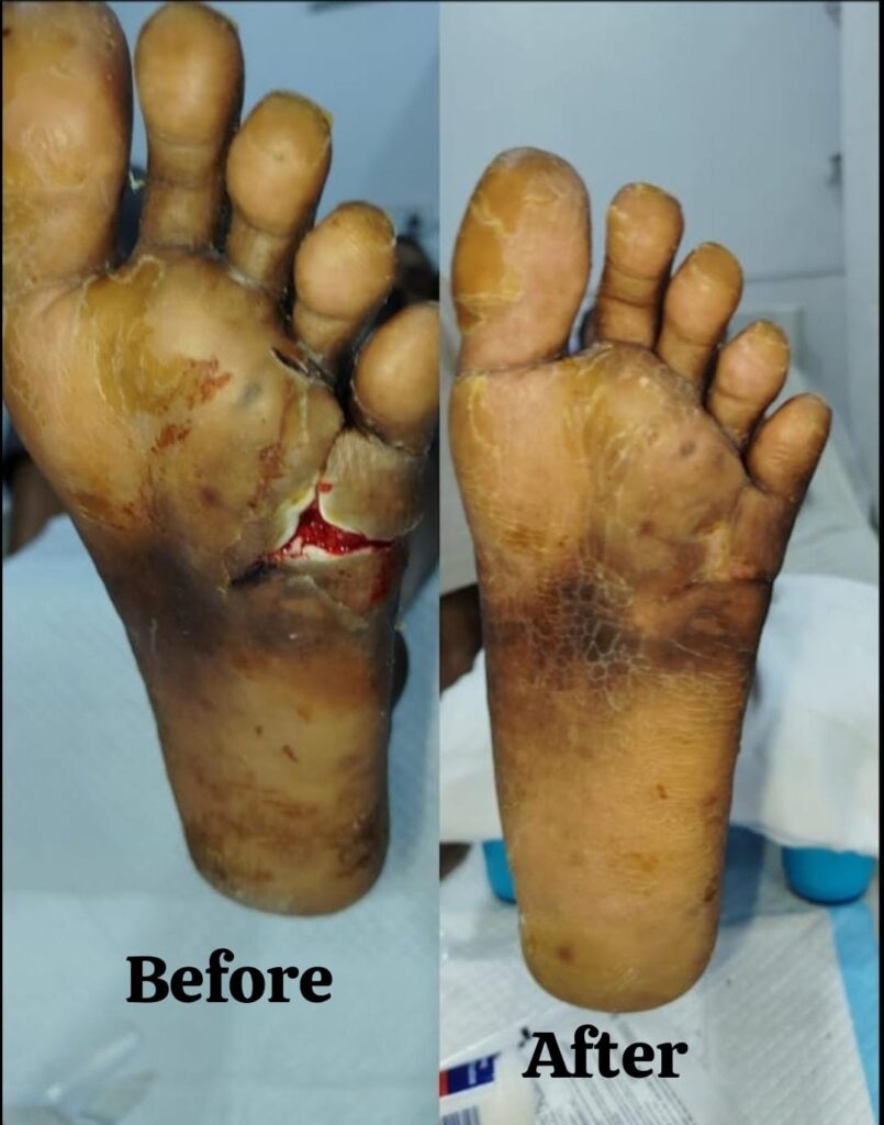 Chennai Diabetic Foot Care Centre | Ph: 9840525242 | Dr. Premkumar ...