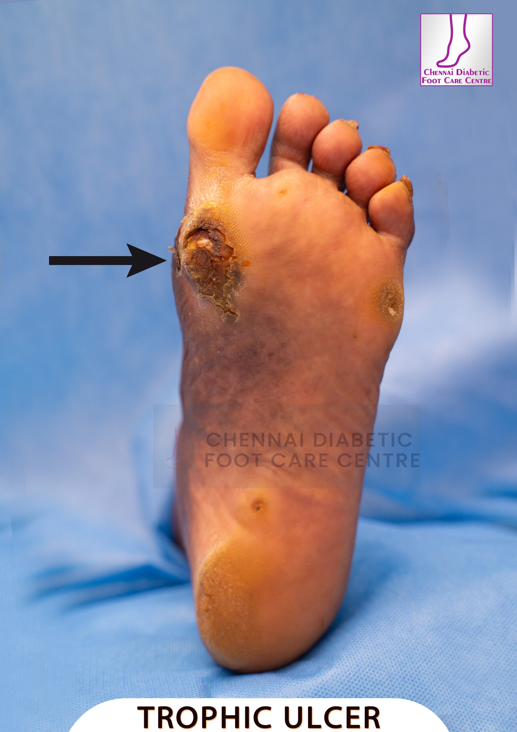 Clinical Cases | Ph: 9840525242 | Chennai Diabetic Foot Care Centre ...